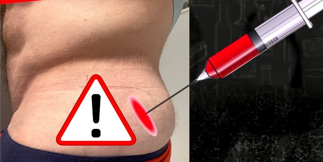 Post-injection pain. Why it may occur and how to avoid it - Steroidify Blog